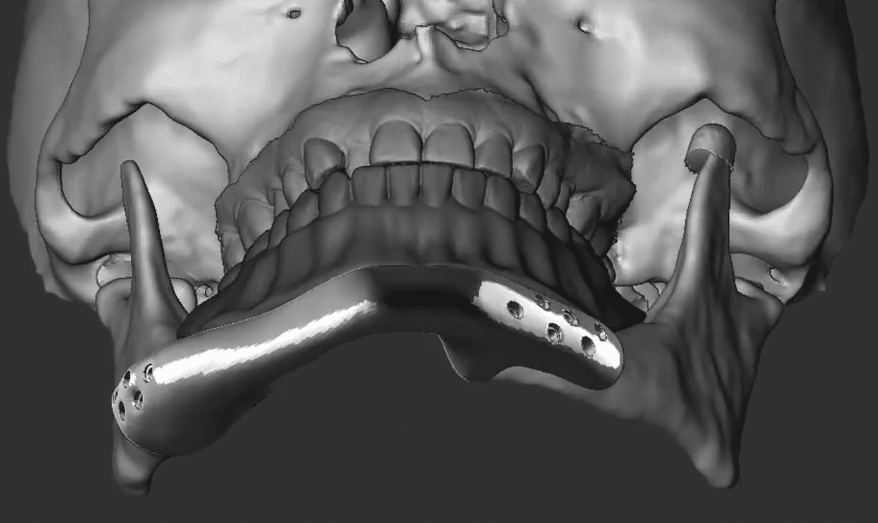 Facial Harmonization Expert In USA | Design My Implants